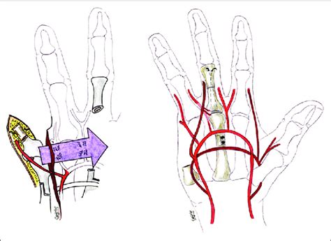 The Fifth Metacarpophalangeal Joint Was Transferred To The Third Finger Download Scientific