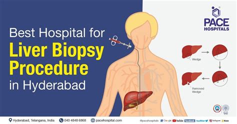 Liver Biopsy Procedure