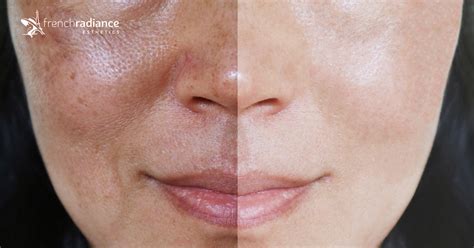 Help Reduce The Effects Of Age Without Surgery