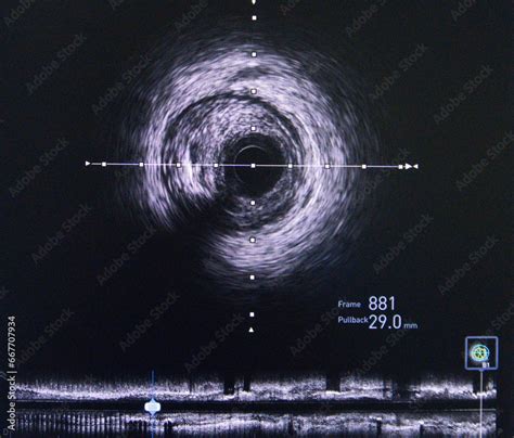 Foto De Intravascular Ultrasound Ivus Was Performed Cross Sectional And Longitudinal Of