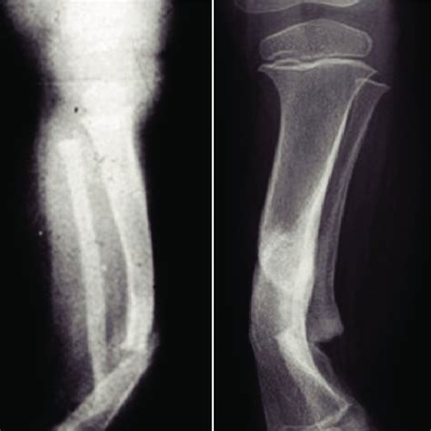 Pdf Pseudarthrosis A Pictorial Essay