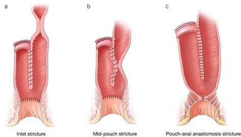 Ileoanal Pouch Anastomosis