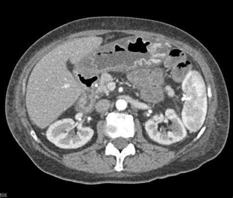 Severe Enteritis Involving The Small Bowel Due To Graft Vs Host Disease