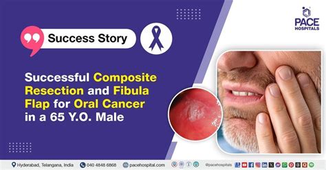 Oral Cancer Treated With Composite Resection And Fibula Flap