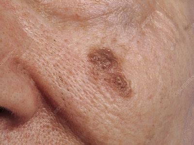 Lentigo Maligna Melanoma Prognosis