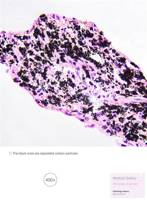 The Lungs Of Smoker Stock Image Image Of Organs Human 367544039