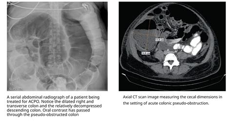 Large Bowel Obstruction Evaluation And Management Pptx