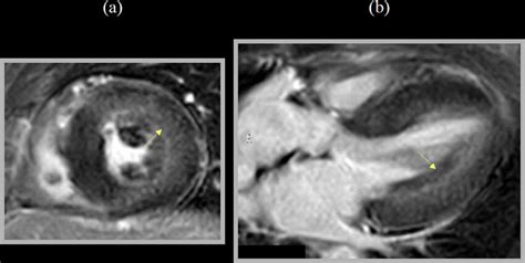 Gadolinium Enhancement Imaging Showed A Late Gadolinium Enhancement