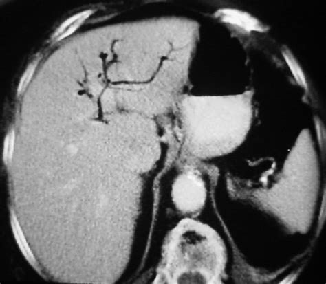 Gallstone Ileus Surgery Photos