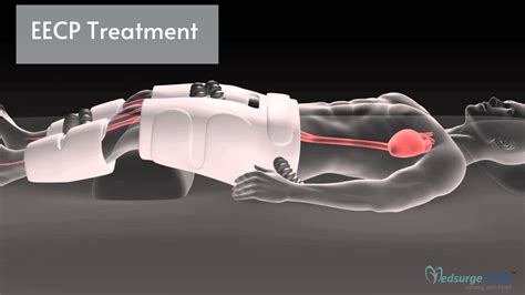 Eecp Treatment Cost In India Eecp Therapy In India Medsurge India