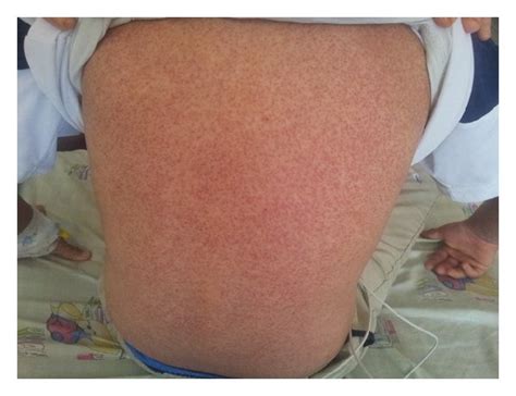 Generalised Maculopapular Rash On Back Download Scientific Diagram