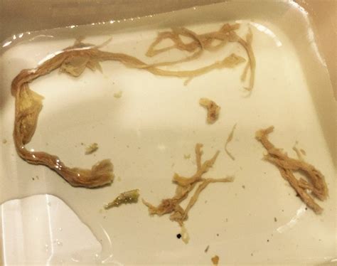 White Worms In Human Stool White Worms In Human Stool