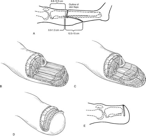 Above And Below Knee Amputation Clinical Tree