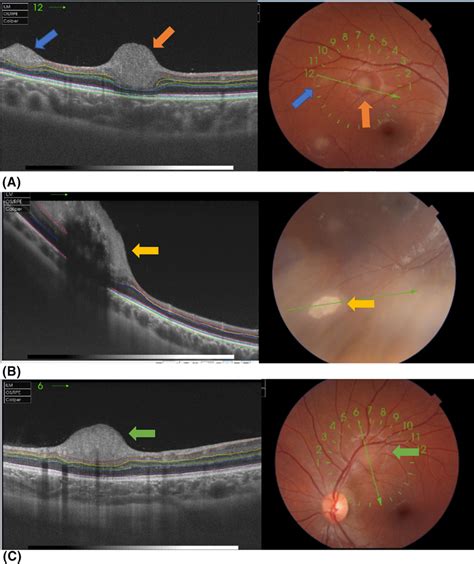 A C Oct Showing Lesion 1 Blue Arrow Mt Of 336 μm Preserved Inner Download Scientific