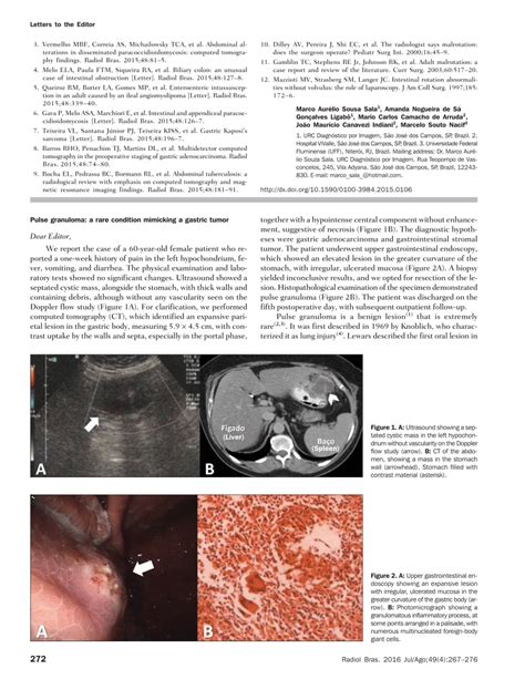 Pdf Pulse Granuloma A Rare Condition Mimicking A Gastric Tumor