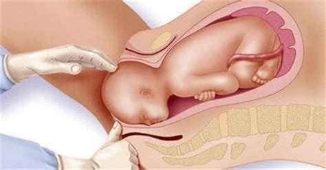 Cesarean Section Delivery In Noida The Gyne Clinic