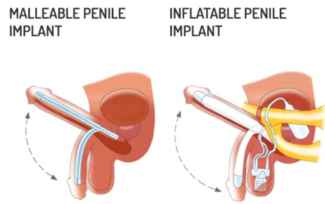 Penile And Scrotal Specialist Penile Prosthesis Surgery And Treatment