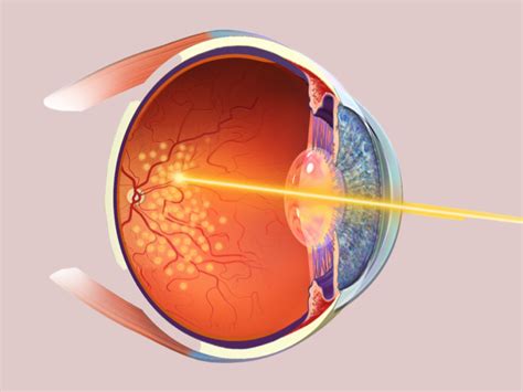 Retinopathy Of Prematurity Rop Stages Irisvision