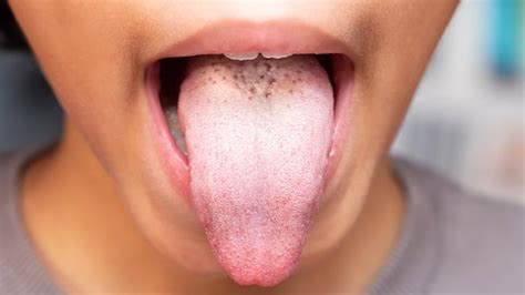causes remedies and risk factors for white tongue onlymyhealth