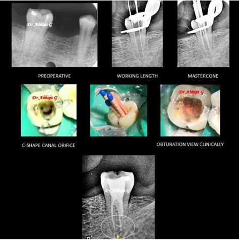 C Shape Canals Are Always With Unpredictable Anatomy Irrigation Plays A Vital Role In