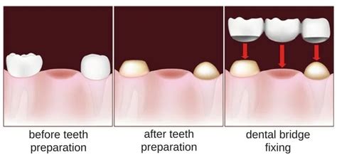 Dental Bridges A Complete Overview