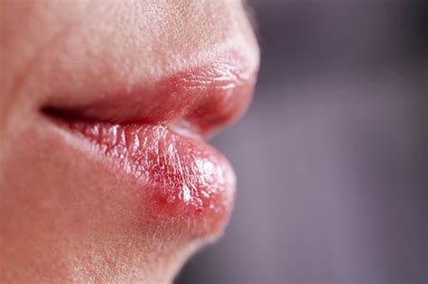Cystic Acne On Lips Causes Treatments And More