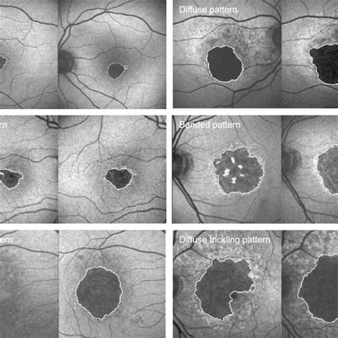 Fundus Autofluorescence Patterns Of Geographic Atrophy Patterns The Download Scientific
