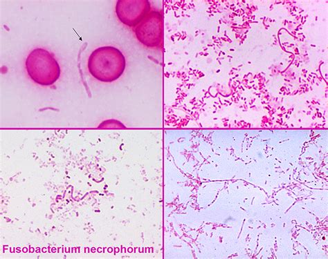 Fusobacterium Necrophorum Treatment