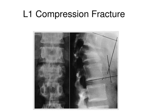 Ppt Spinal Injury Powerpoint Presentation Free Download Id388407