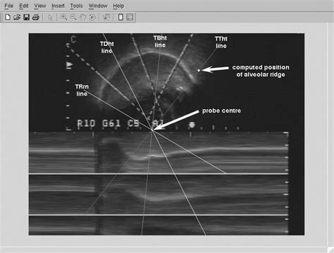 8 Ultrasound Frame In Matlab Showing Four Measurement Lines Download
