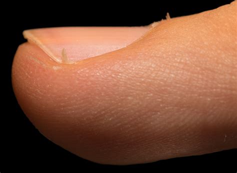 Hangnail