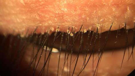 Microscopic Bugs On Eyelashes