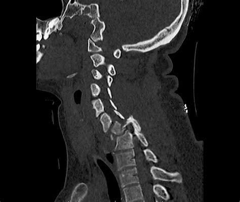 Dislocated Neck Vertebrae