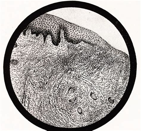 Figure 1 From Tuberculosis Of The Body And Cervix Of The Uterus Semantic Scholar