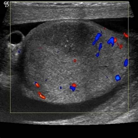 Absence Of Color Doppler Signal In The Same Patient Indicating Ischemic