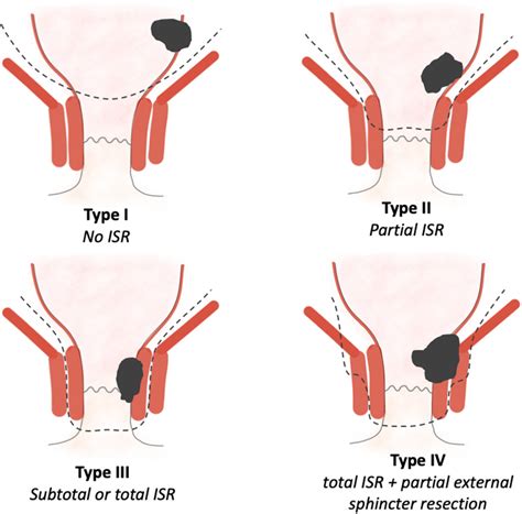 Four Different Options Of Intersphincteric Resection Download