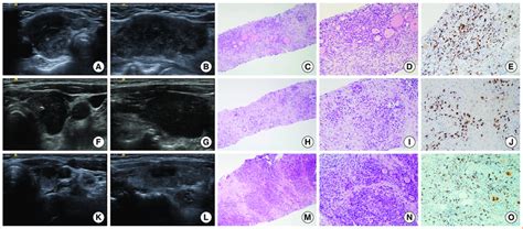 Thyroid Ultrasonography Us Shows A Solid Irregular Shaped Hypoechoic