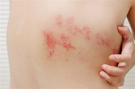 帯状疱疹はうつる初期症状と治療法｜富田るり子皮膚科クリニック