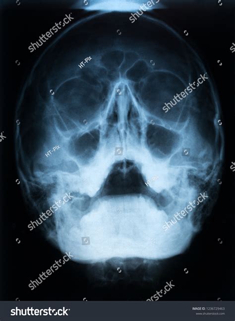 Imaging Of Maxillary Sinusitis Waters View Ct Scan Mri