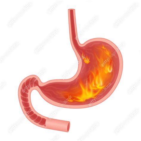Realistic Medical Illustration Of Pyrosis Stomach Isolated Fire