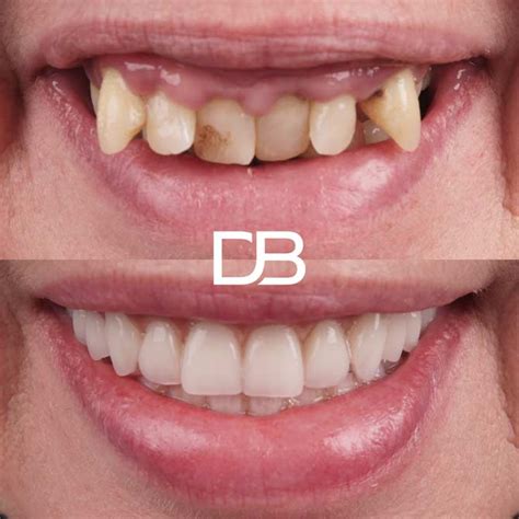Veneers Before And After Crooked Teeth Turkey Teeth Before And After