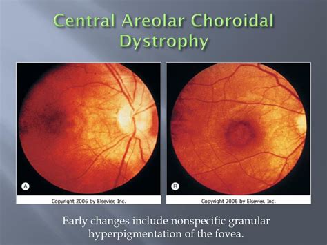 Ppt Hereditary Choroidal Disease Powerpoint Presentation Free
