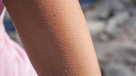 Goose Pimple Skin