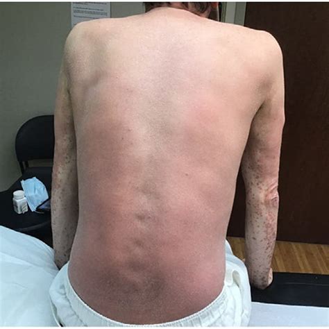 Erythroderma And Islands Of Sparing Download Scientific Diagram