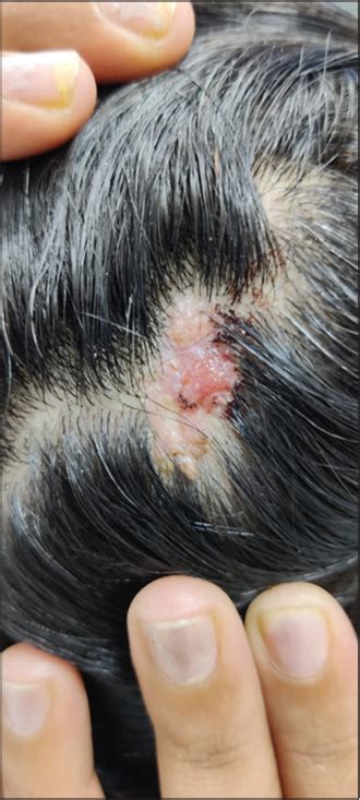 Verrucous Outgrowth On Scalp Cosmoderma