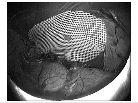 Endoscopic Image Showing Placement Of A Polypropylene Mesh Overlapping Download Scientific