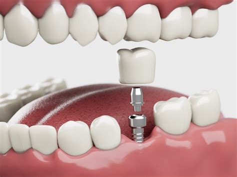 Dental Implant In Korea Affordable And Advanced Dental Care