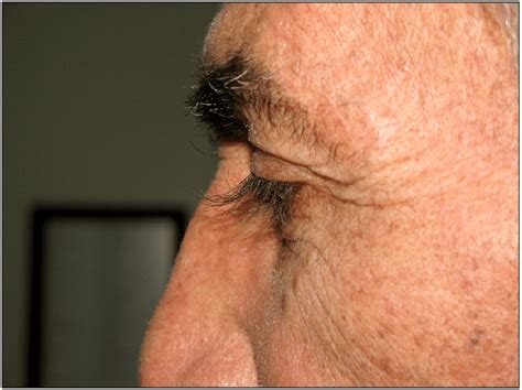 Eyelash Elongation After Cetuximab Treatment Published With Permission