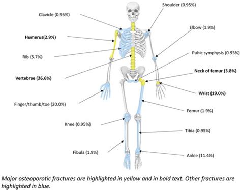 Full Article Clinical Utility Of The Fracture Risk Assessment Tool