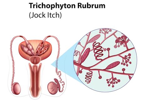 Trichophyton Vectors And Illustrations For Free Download Freepik